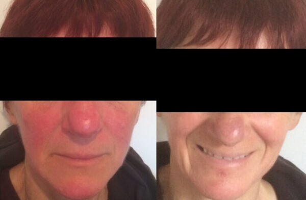 DemoDerm Rosacea Basic Care - Buy now!